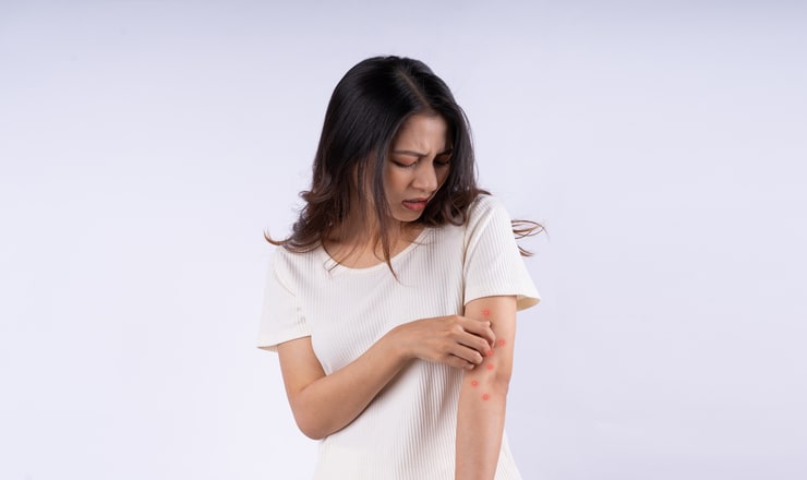 Lupus (Systemic Lupus Erythematosus): Gejala, Penyebab, dan Pengobatan