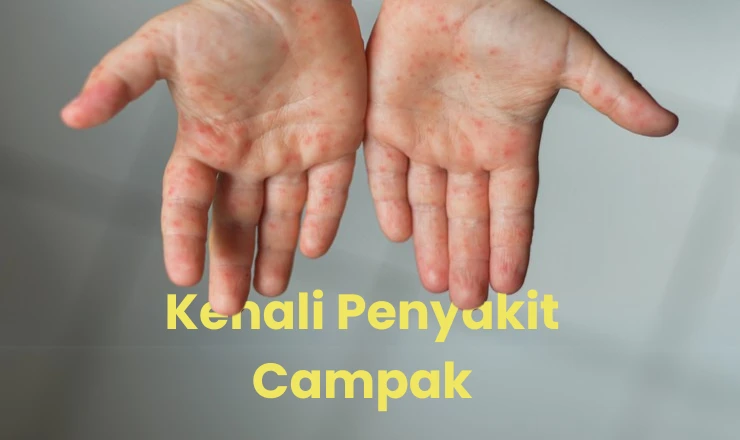Penyakit Campak: Gejala, Penyebab, Pencegahan, Serta Perawatannya