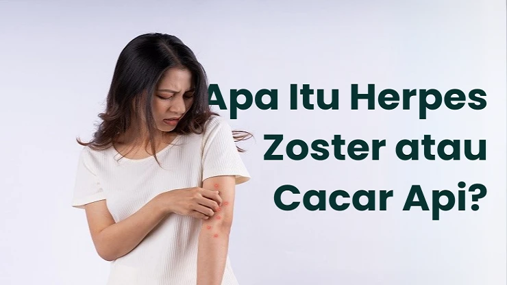 Cacar Api: Penyebab, Gejala, dan Cara Mencegah yang Efektif