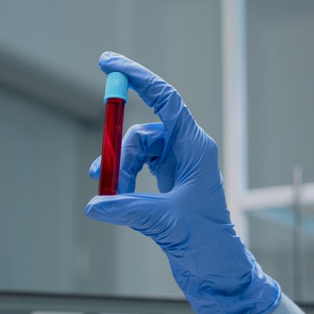 Penyebab Hb Rendah: Kenali 11 Faktor dan Solusinya untuk Mengatasi Anemia