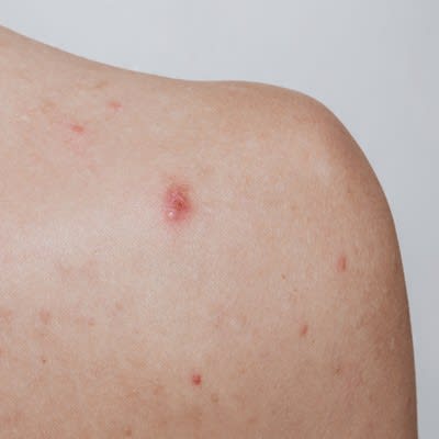 Effective Boil Treatment: Tablets, Ointment, and Powder