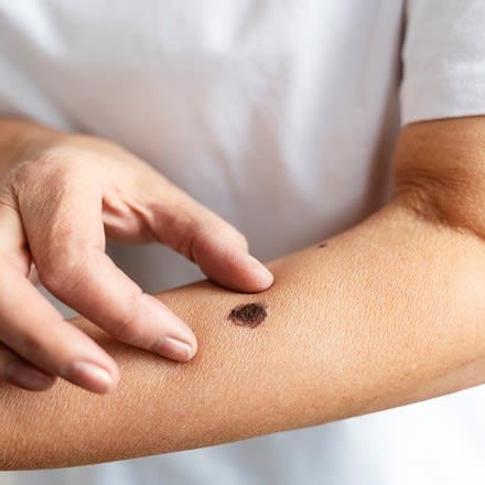 Skin Cancer: The Causes, Symptoms, and Treatment