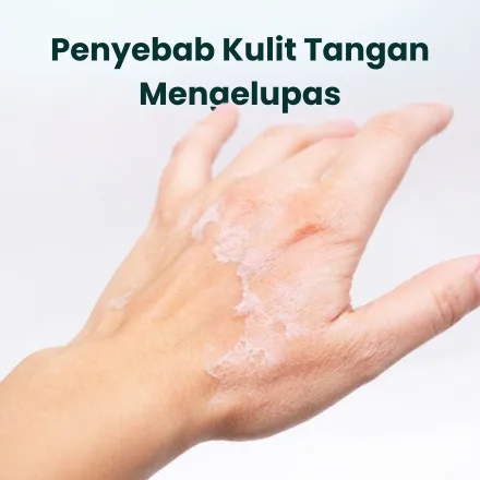 Kulit Tangan Mengelupas? Ini 9 Penyebab dan Cara Mengatasinya