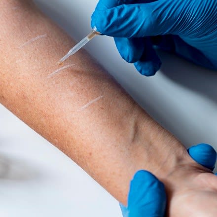 Allergy Test: Know the Procedure, Cost, and the Right Time to Do It