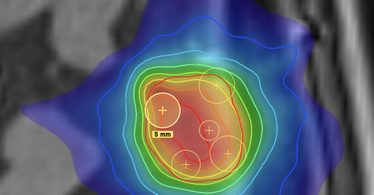 ZAP Surgical Systems - Reaktor