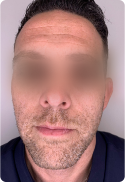 SUBDERMA - טיפולי עור מתקדמים למראה חלק ובריא