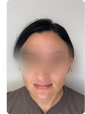 SUBDERMA - טיפולי עור מתקדמים למראה חלק ובריא