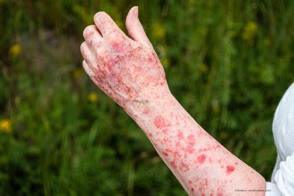 Sonnenallergie: Symptome, Hausmittel & wichtige Schutzmaßnahmen