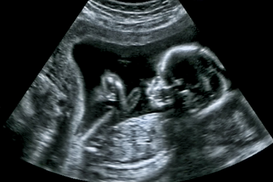 Companies admit illegal fetal tissue sales, end California operations ...