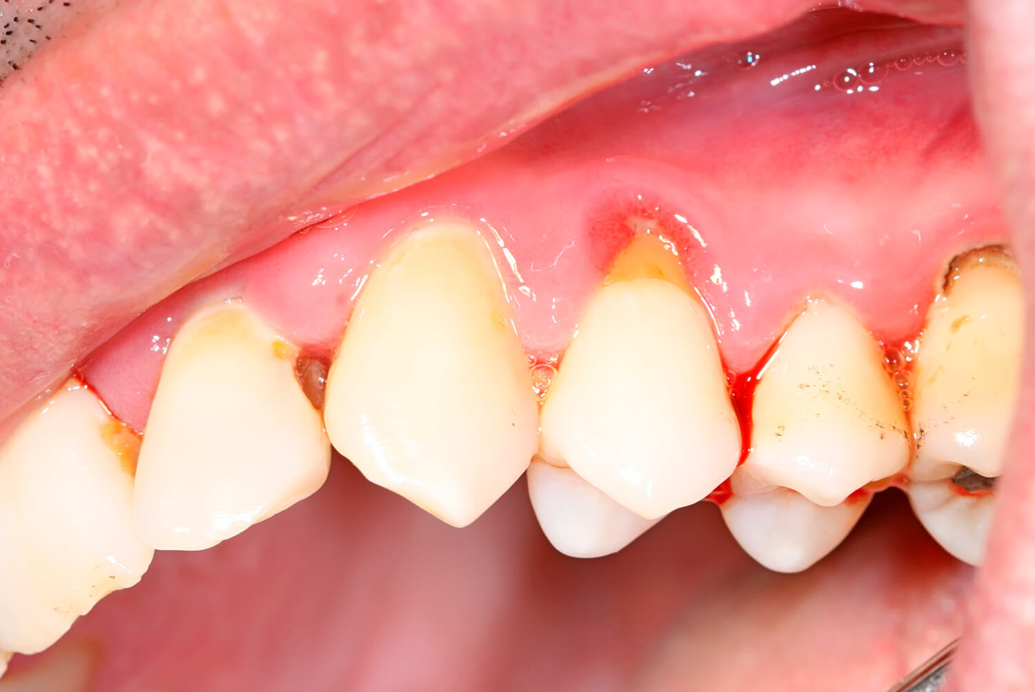 Gingivitis: qué es, causas, tipos y tratamientos | Ferrus&Bratos