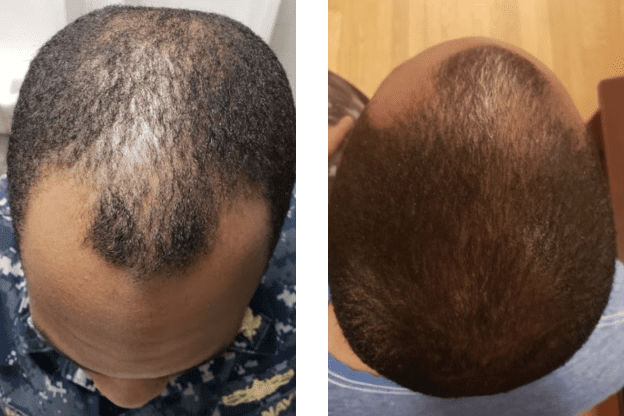Hair Loss Treatment Products For Men | hims