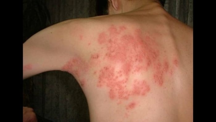 Experts say young people are at risk of shingles