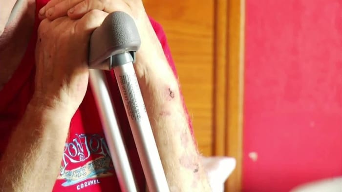 70-year-old man tells story of attack, fire that nearly killed him