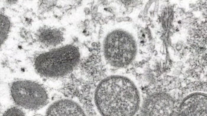 Virginia health officials hope Monkeypox messaging will decrease STI rates