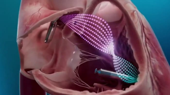 The new ‘no surgery, no wires’ pacemaker