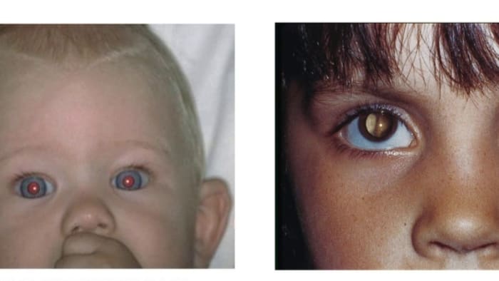 Ce que vos photos Instagram pourraient révéler sur la santé de vos yeux ...