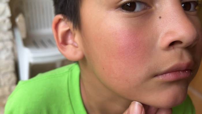 ‘Slapped cheek’ rash is identifying characteristic of fifth disease in ...