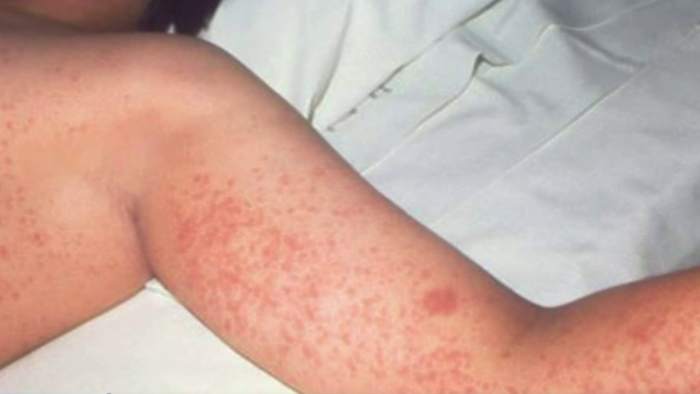 Measles outbreak spreading amongst kids in Ohio