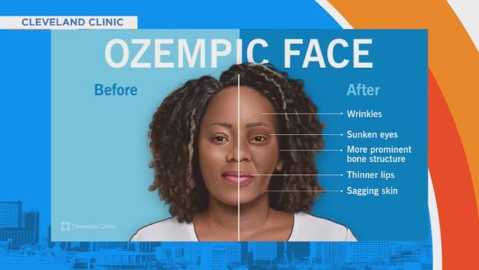 ‘Ozempic Face’ is aging patients who just want to lose weight