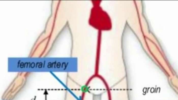 What is a femoral pulse? Doctors weigh in as mother’s concern over ...