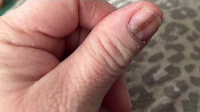 Woman diagnosed with melanoma on fingernail. What you need to know ...