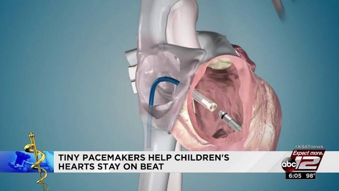 Video: Cardiologists using tiny pacemaker for kids with congenital ...