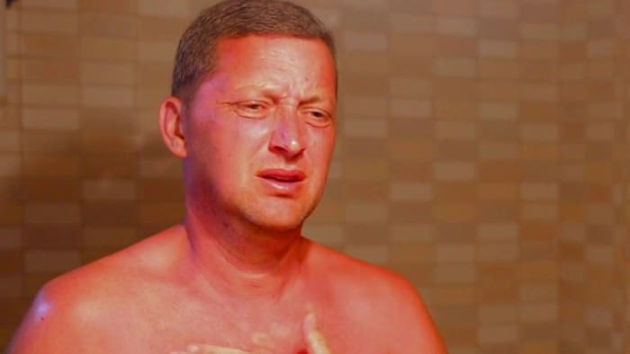🥵Got sunburn? Here’s how to treat, prevent it