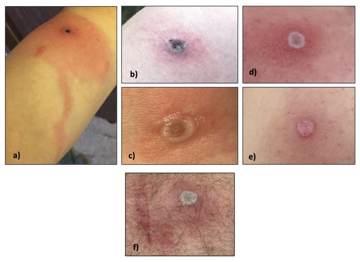 What is Alaskapox? Recent death brings attention to virus seen in small ...