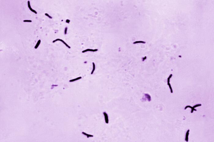 Active tuberculosis case detected at West Michigan school