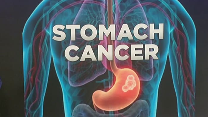 What to know about stomach cancer after Toby Keith’s death