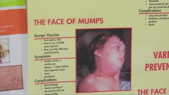 mumps outbreak texas