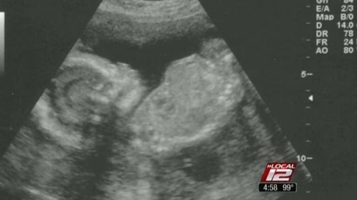 Doctors warn of using ultrasounds for entertainment