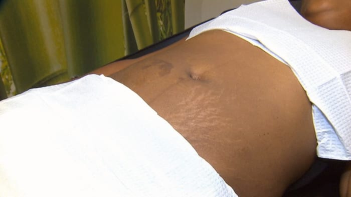 Get rid of stretch marks, acne scars