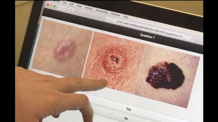 Students create app to detect skin cancer at home