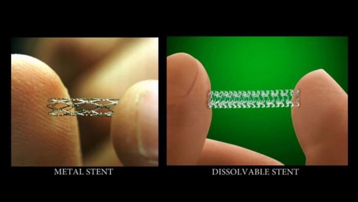 Dissolving Stents: Do Your Homework