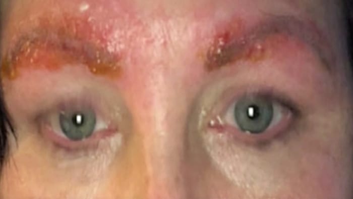 Woman gets potential life-threatening infection after microblading eyebrows