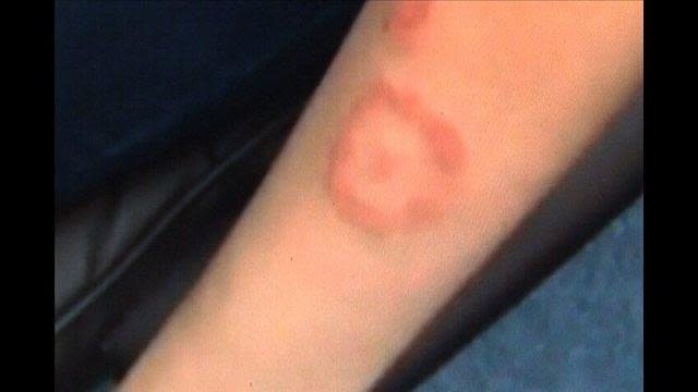 ringworm from insect bite