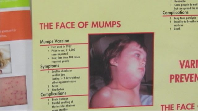 mumps outbreak
