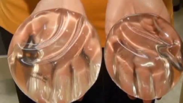 silicone implants gone wrong