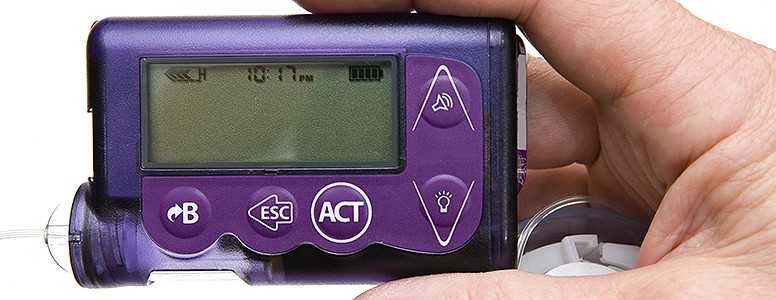 Insulin pumps safe and effective for up to five years in patients with ...
