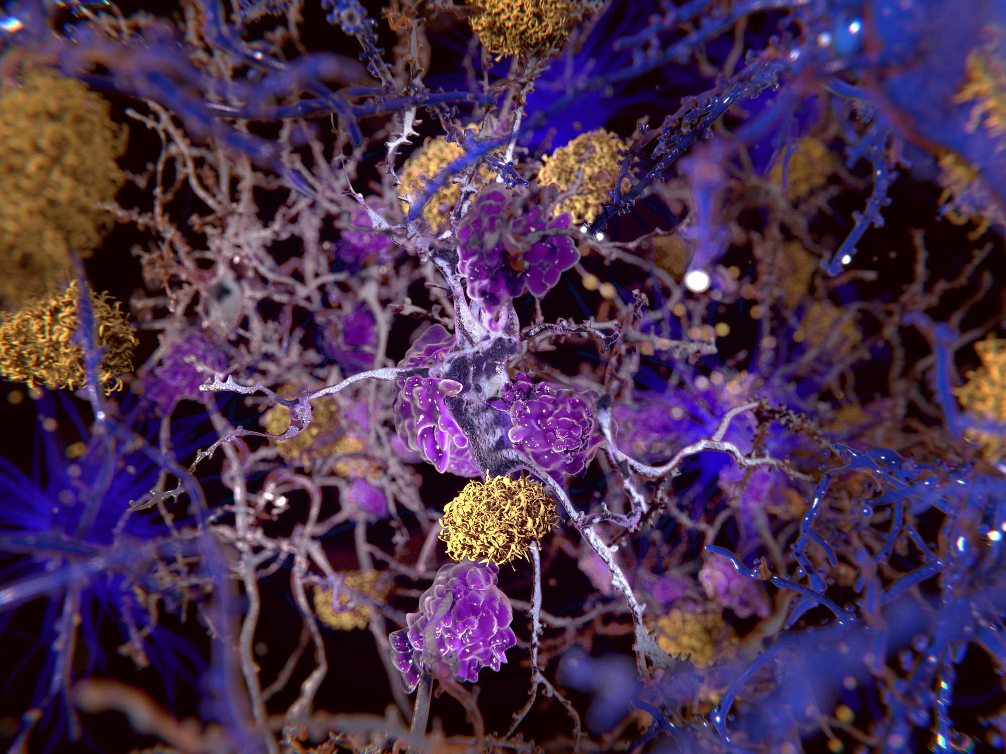 Hyperglycaemic Hyperosmolar Nonketotic Coma (HONK)