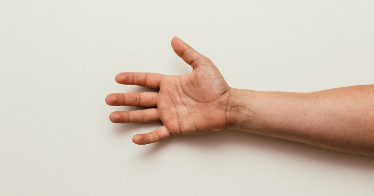 Flexor Tenosynovitis (Trigger Finger)