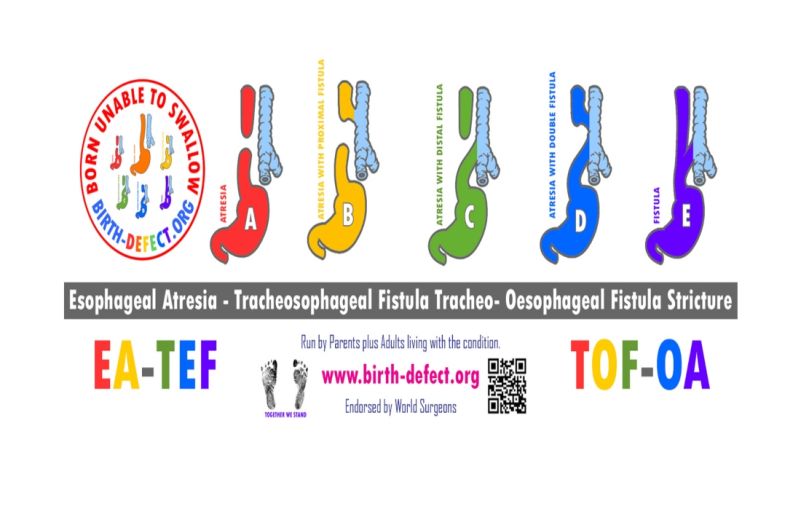 Esophageal Atresia & TEF