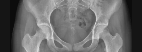 PSMA-RADS 2.0 Improves Prostate Cancer Imaging