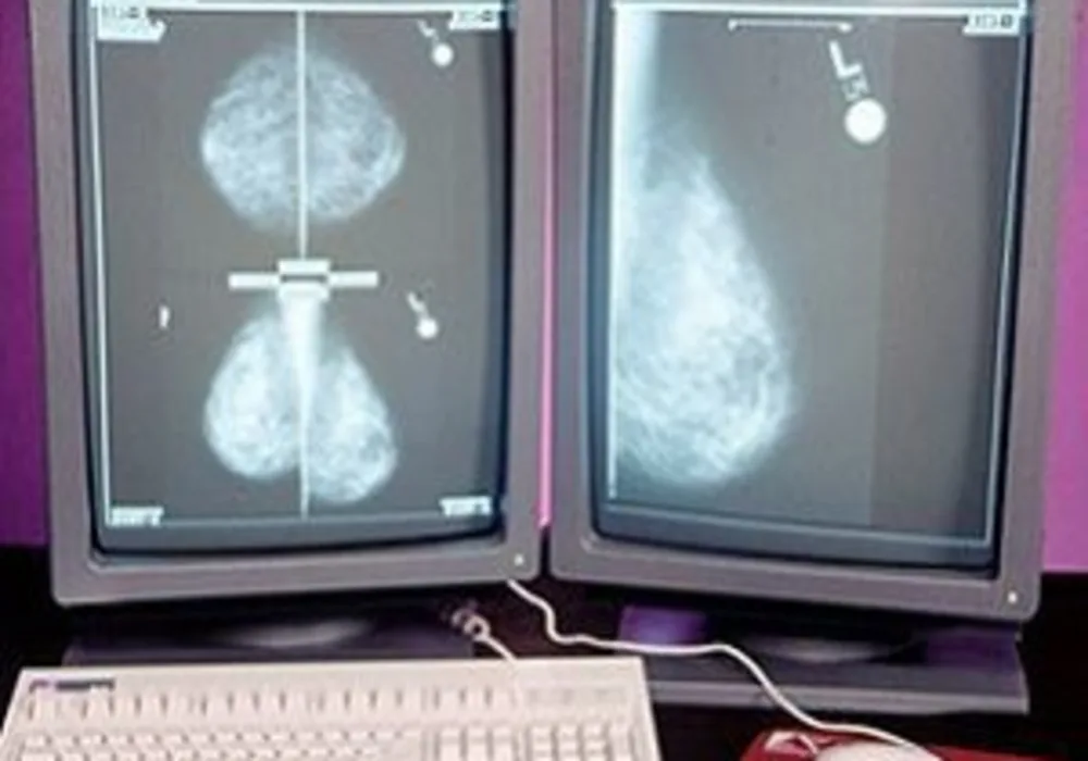 Study: CAD Plus Digital Mammography No Better than Radiologist Alone