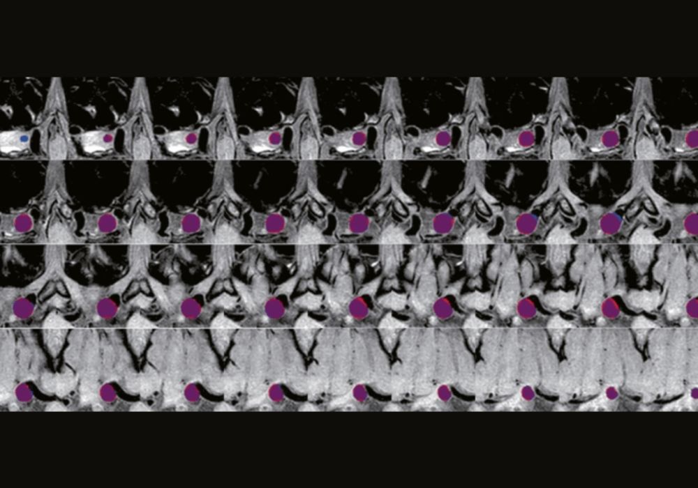 Pioneering Deep Learning in Intracranial Aneurysm Detection