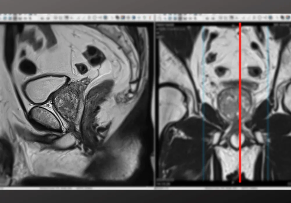 ESR Essentials: Prostate MRI Scoring System ESUR Recommendations