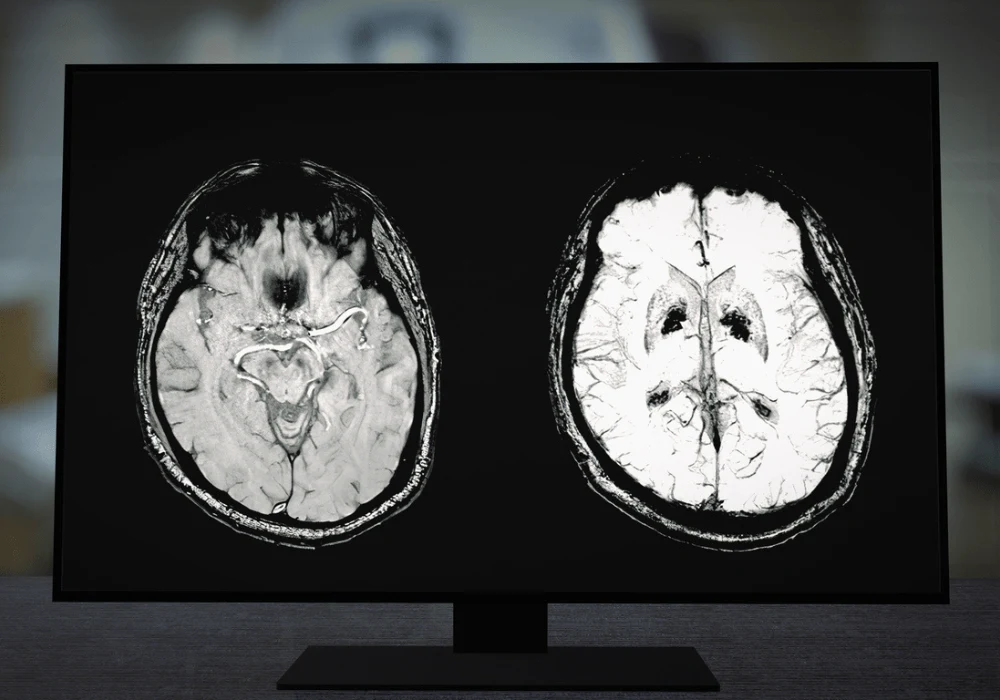 Enhancing Brain MRI Lesion Detection with Deep Learning & Radiology Reports