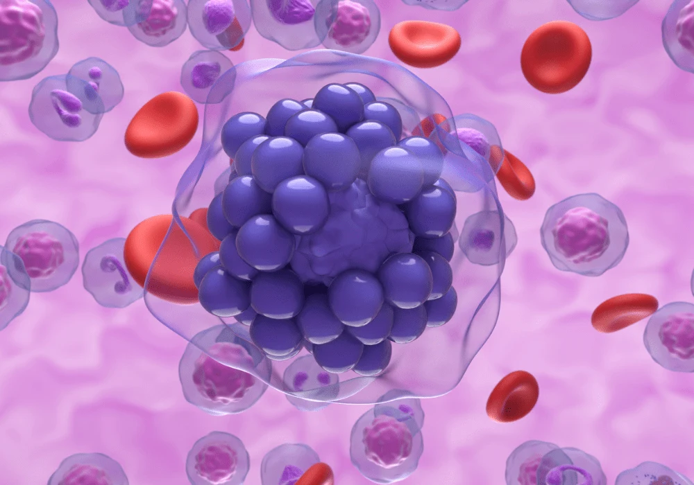 Advancing Prognosis in Diffuse Large B-Cell Lymphoma