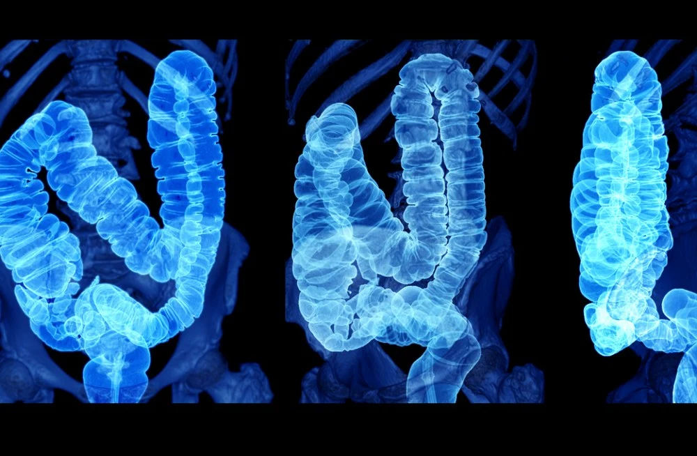 Enhancing Radiologists’ Decision-Making: AI in Colorectal Polyp ...